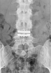 Disc prosthesis / ADR | Beta Klinik Bonn